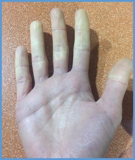 ¿Qué es una capilaroscopia? La técnica para estudiar el Fenómeno de ...